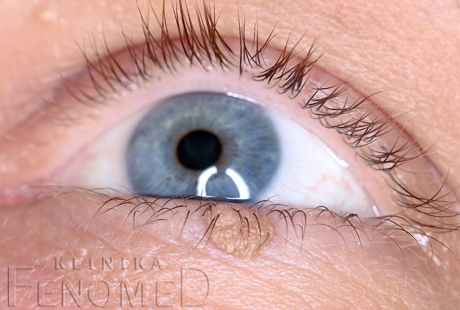 Brodawki wirusowe - Diagnostyka, Skuteczne Leczenie - 30 lat doświadczenia