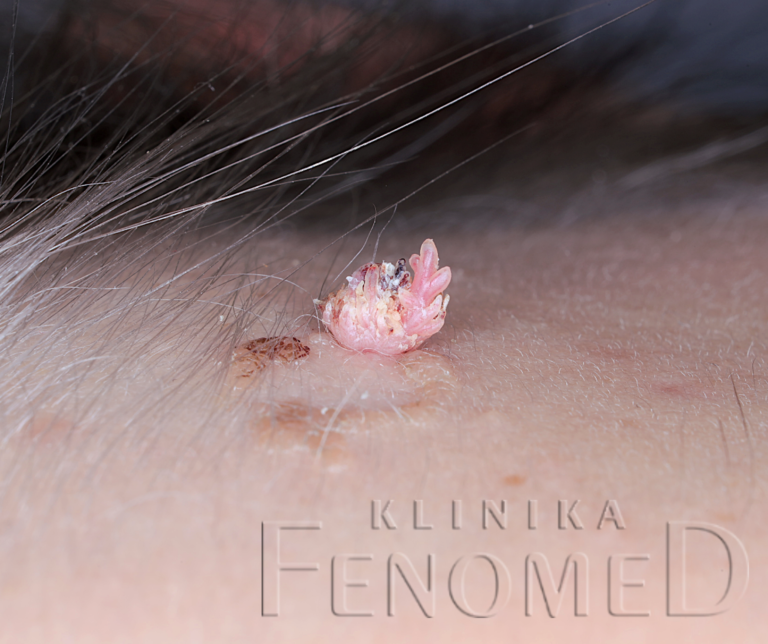 Brodawki wirusowe - Diagnostyka, Skuteczne Leczenie - 30 lat doświadczenia