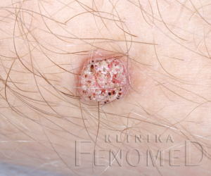 Brodawki wirusowe - Diagnostyka, Skuteczne Leczenie - 30 lat doświadczenia