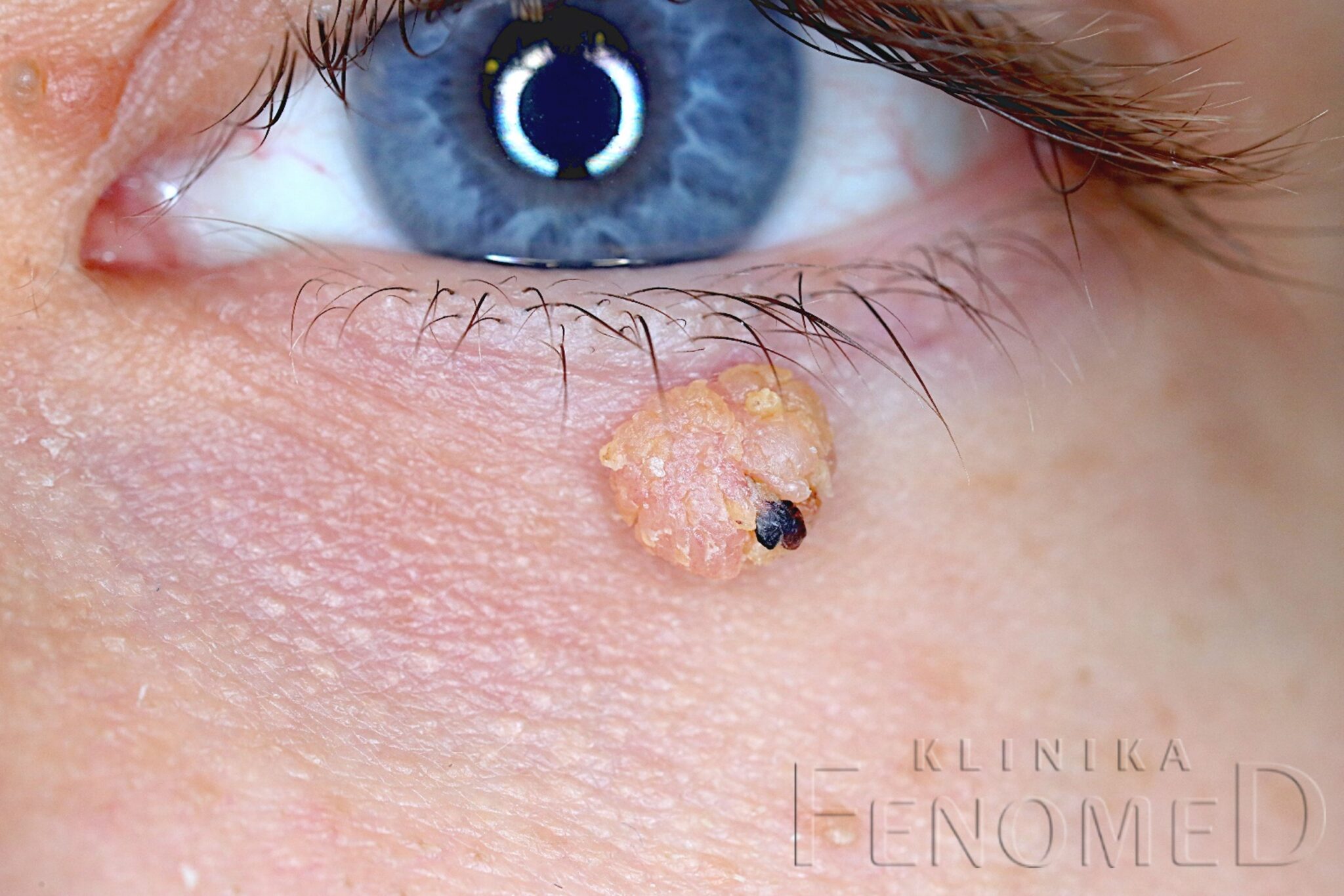 Brodawki wirusowe - Diagnostyka, Skuteczne Leczenie - 30 lat doświadczenia