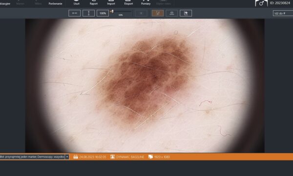 Wideodermatoskopia i mapowanie znamion - Klinika Fenomed